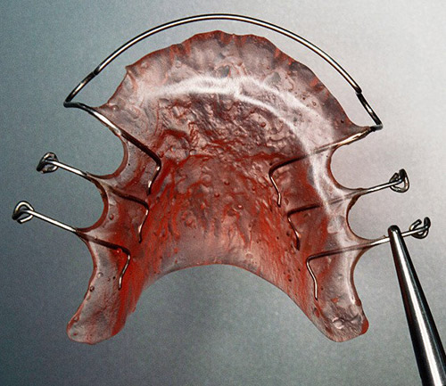 Removable Retainers | IQ Braces and Faces