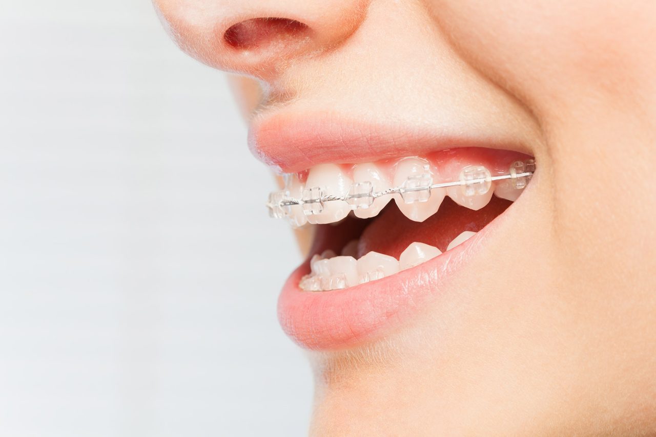 Ceramic Braces | IQ Braces and Faces